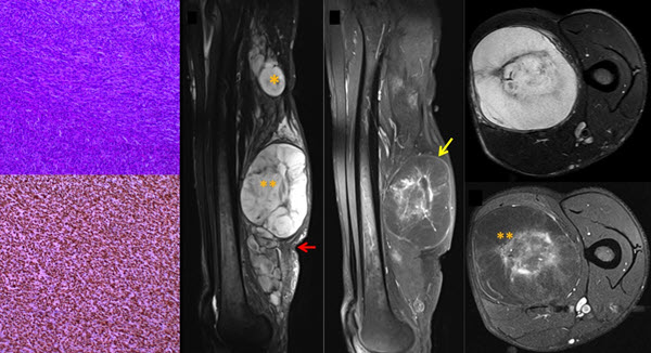 Neurofibromatosis Type 1 Radiology