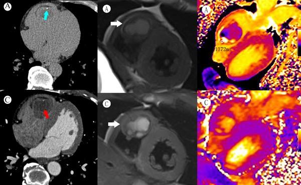Multimodality imaging toward diagnosis of an intraventricular ...