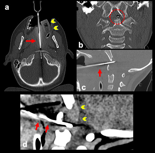 The CT guided transoral approach: A biopsy technique for a poorly ...