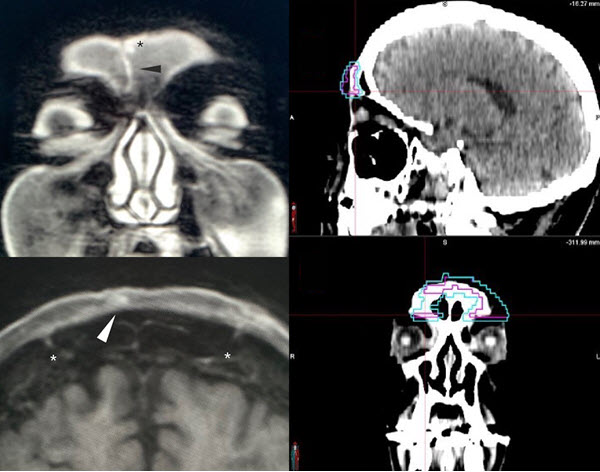 Squamous Cell Carcinoma with Clinical Perineural Invasion: Challenges ...