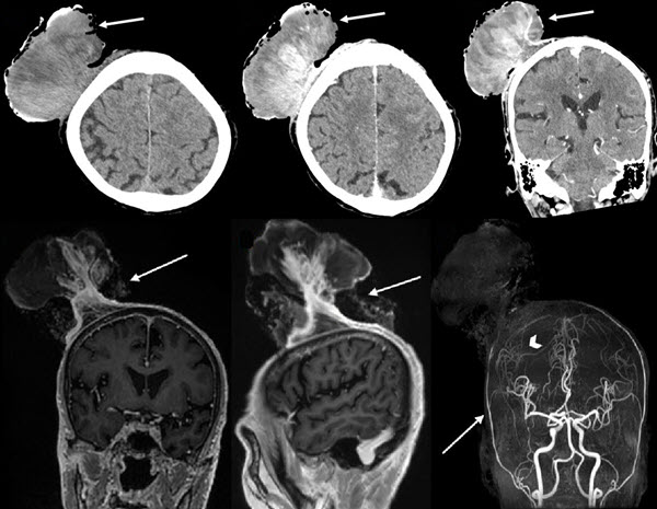 Primary Epithelioid Sarcoma Manifesting as a Fungating Scalp Mass ...
