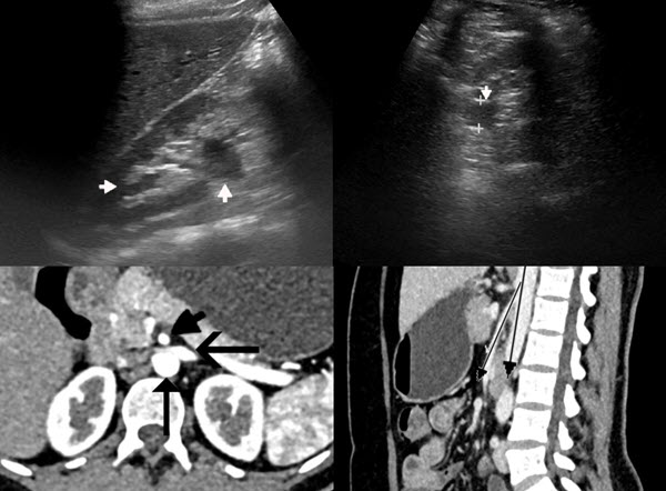The Nutcracker Syndrome | Ismailoglu | Journal of Radiology Case Reports