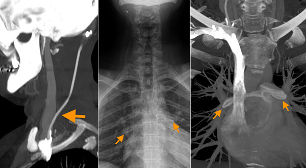 Radiological correlation of mechanism of intravascular migration of the ...