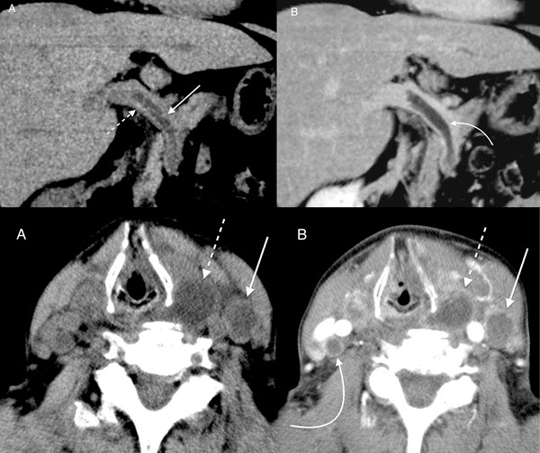 Use of intravascular hypo- and hyper-attenuation on non-contrast ...