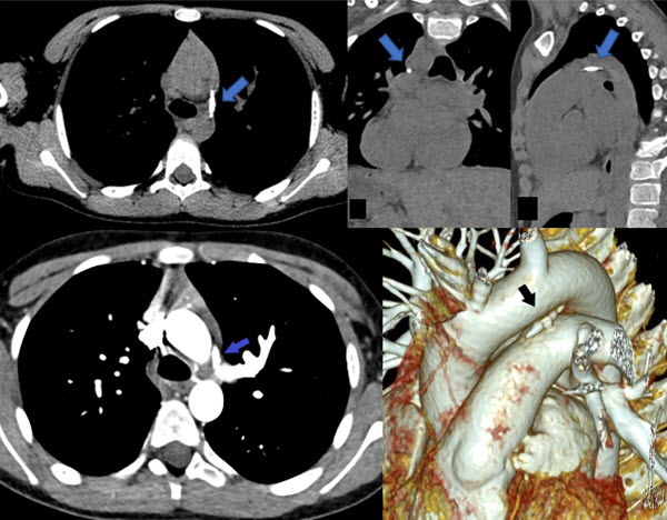 Esophageal ingested body in a child with calcified ligamentum ...