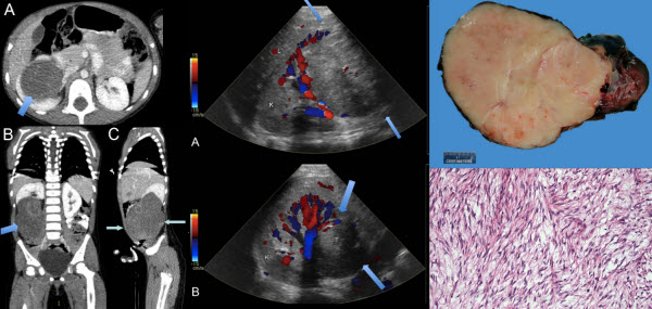 A Case of Clear Cell Sarcoma of the Kidney | Franco | Journal of ...