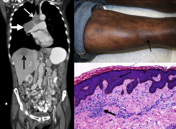Acrokeratosis paraneoplastica (Bazex syndrome): Report of a case ...