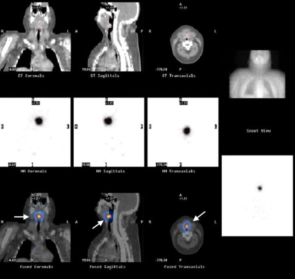 Iodine 131 ablation of an obstructive lingual thyroid | Patel | Journal ...