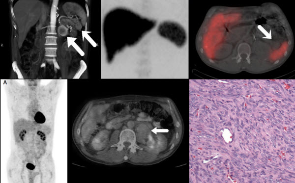 F-18 FDG PET/CT and Tc-99m Sulfur Colloid SPECT imaging in the ...