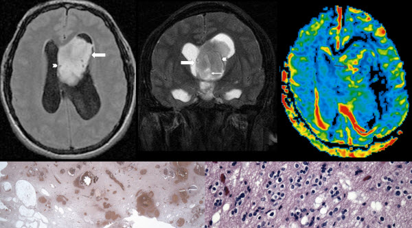 Unusual Appearance and Presentation of Supratentorial Subependymoma in ...